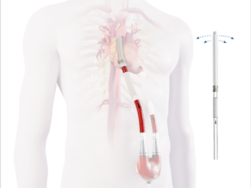 Berlin Heart gibt CE-Kennzeichnung und erste Implantation der neuesten ...